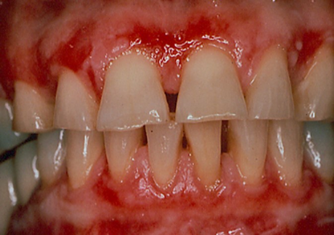 Oral Mucosal Diseases: Puzzling Conditions in Complicated Patients ...