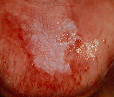 Oral Mucosal Diseases: Puzzling Conditions in Complicated Patients ...