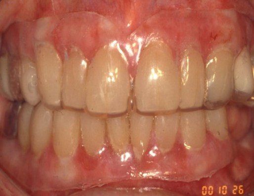 Oral Mucosal Diseases: Puzzling Conditions in Complicated Patients ...