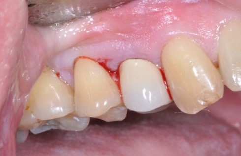 A New Standard of Care: Offer Ridge Preservation for Implant Treatment ...