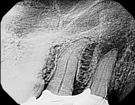 A New Standard of Care: Offer Ridge Preservation for Implant Treatment ...